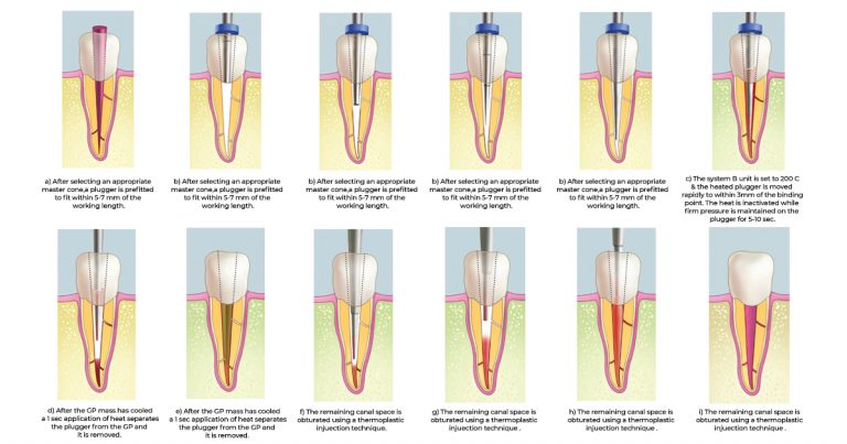 Effective Obturation Techniques for Successful Root Canal Treatments ...