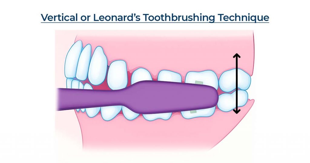 Toothbrushing Techniques: Choosing the Best Method for Patients