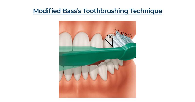 Toothbrushing Techniques: Choosing the Best Method for Patients