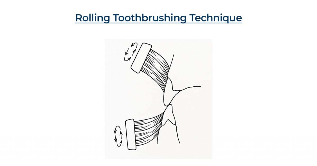 Toothbrushing Techniques: Choosing the Best Method for Patients
