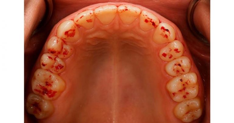 Dental Articulating Paper Guide: Types, Uses, and Which One to Use When ...