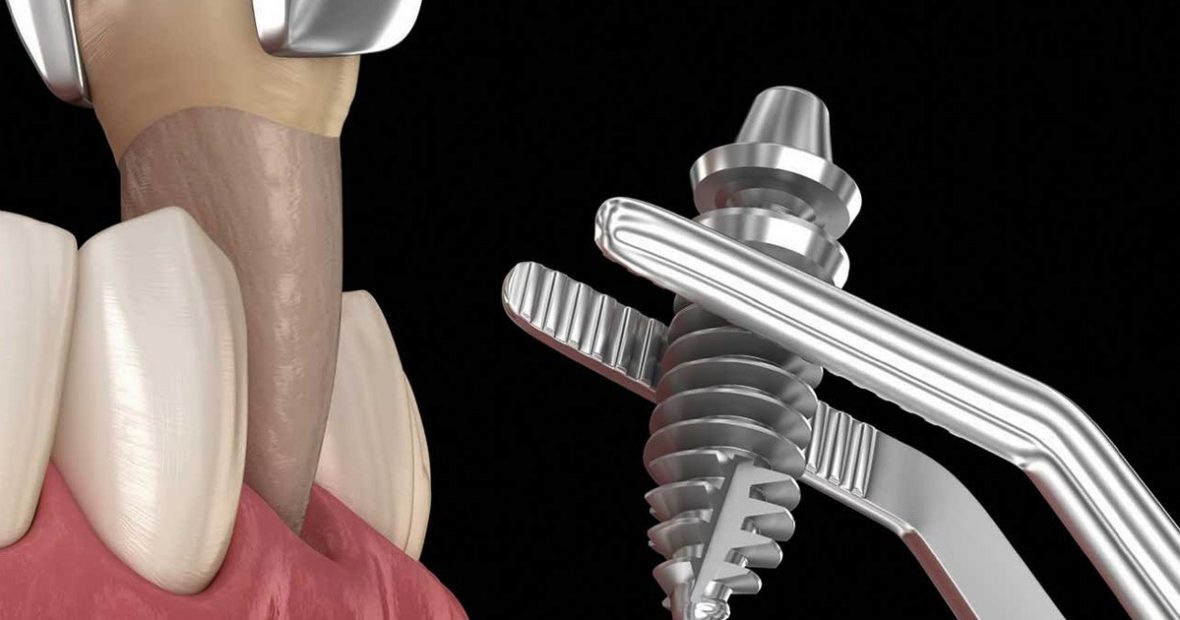 Dental Trauma: Clinical Guide to Ellis Classification & Management